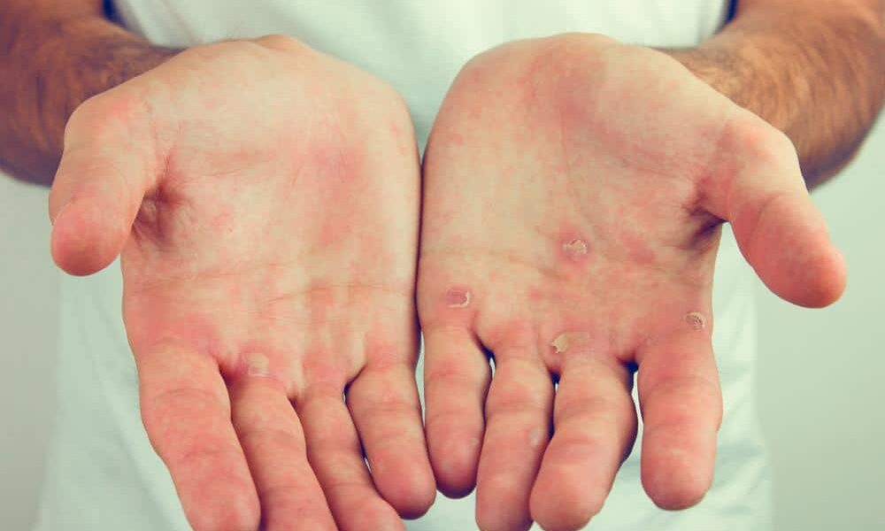 Consejos para tratar y prevenir el callo en la mano de forma natural ...