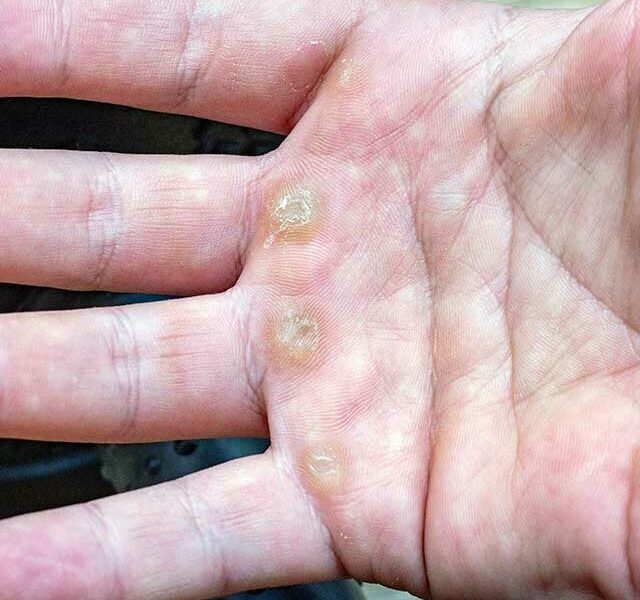 Cómo aliviar y prevenir los callos en las manos: Consejos prácticos ...