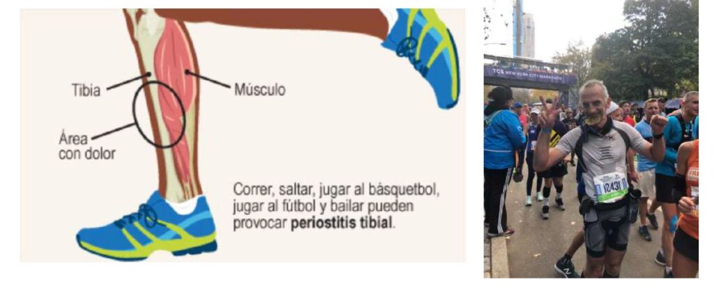 Periostitis tibial: causas, síntomas y tratamiento efectivo - Es Nutrición